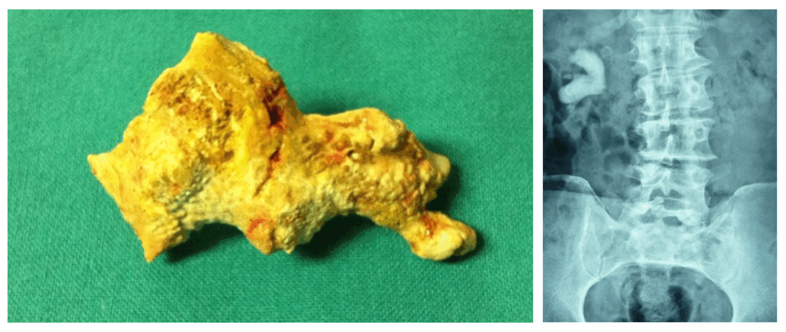 Kidney Stones: Causes, Symptoms, and How to Prevent Them - Dr MC Conradie